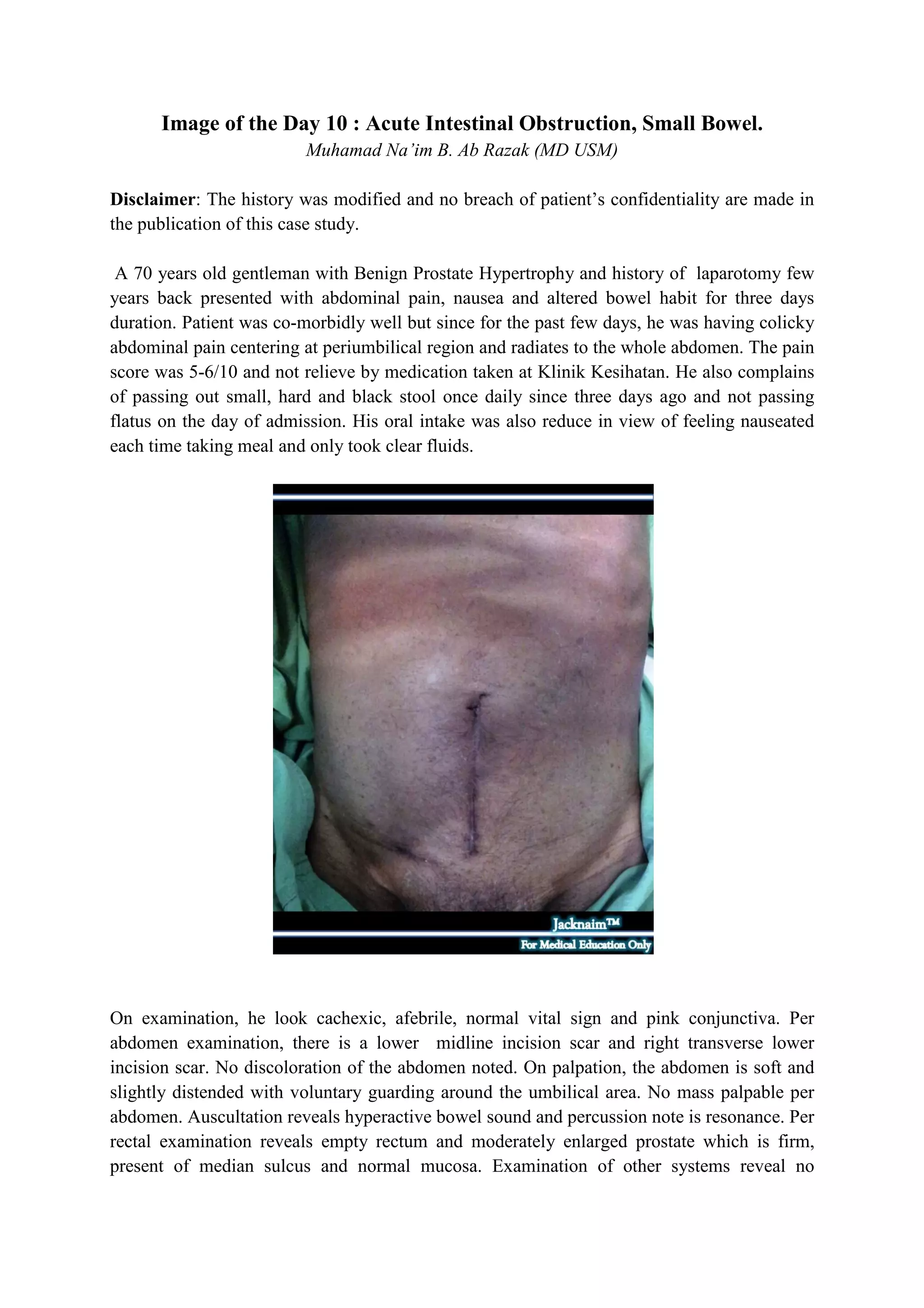 Acute intestinal obstruction, small bowel | PDF