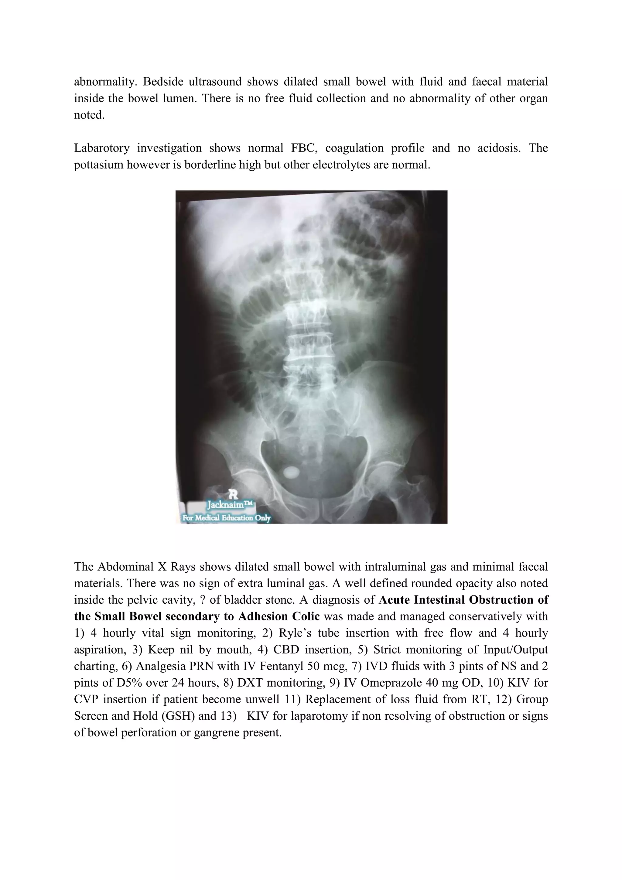 Acute intestinal obstruction, small bowel | PDF