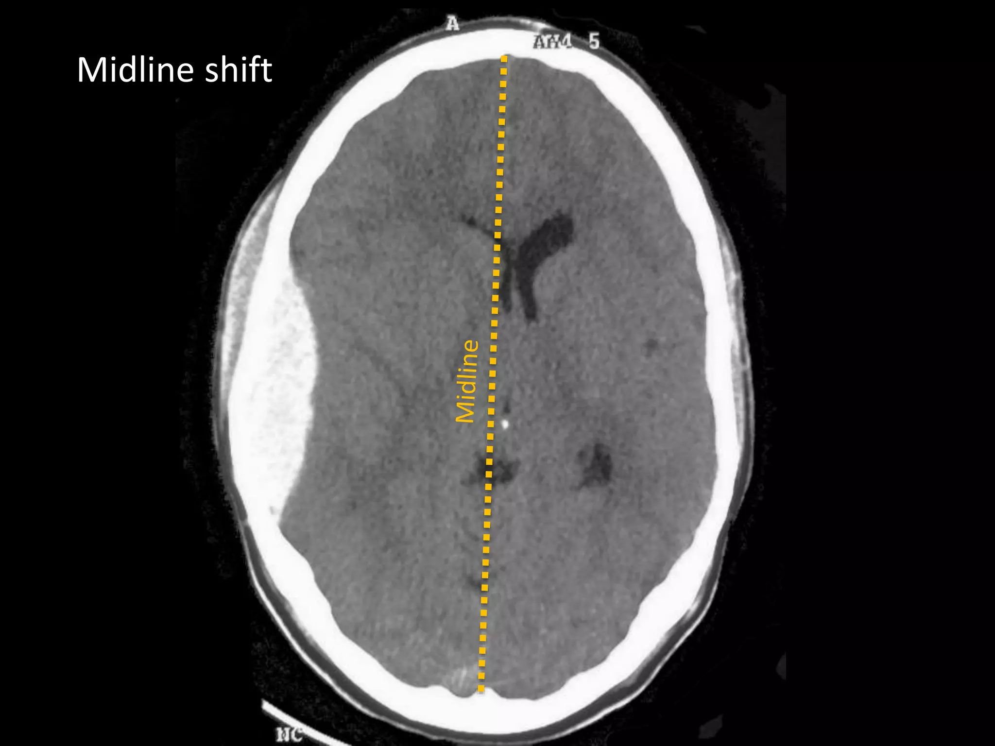 CT of acute intracranial pathology | PPTX