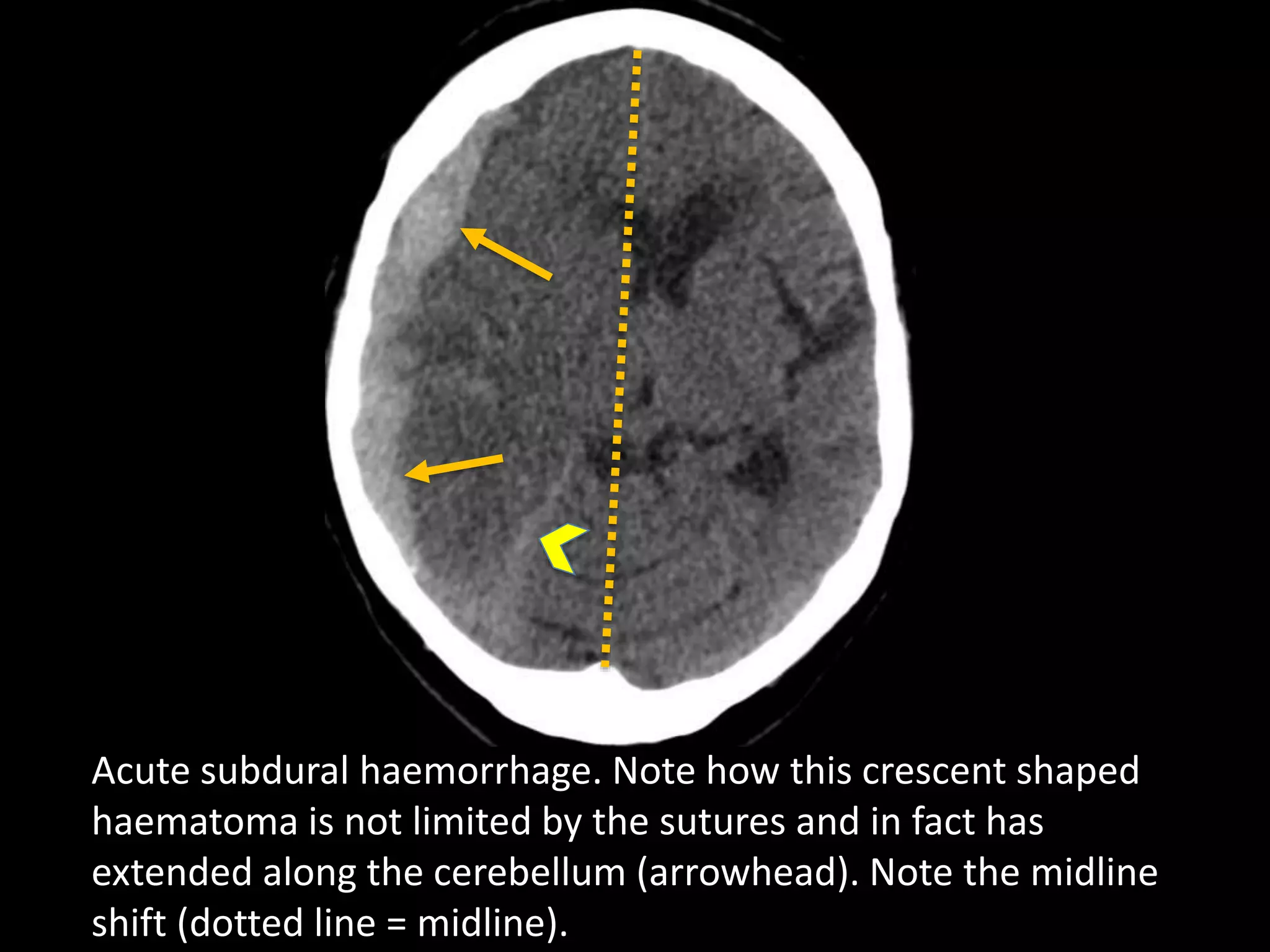 CT of acute intracranial pathology | PPTX