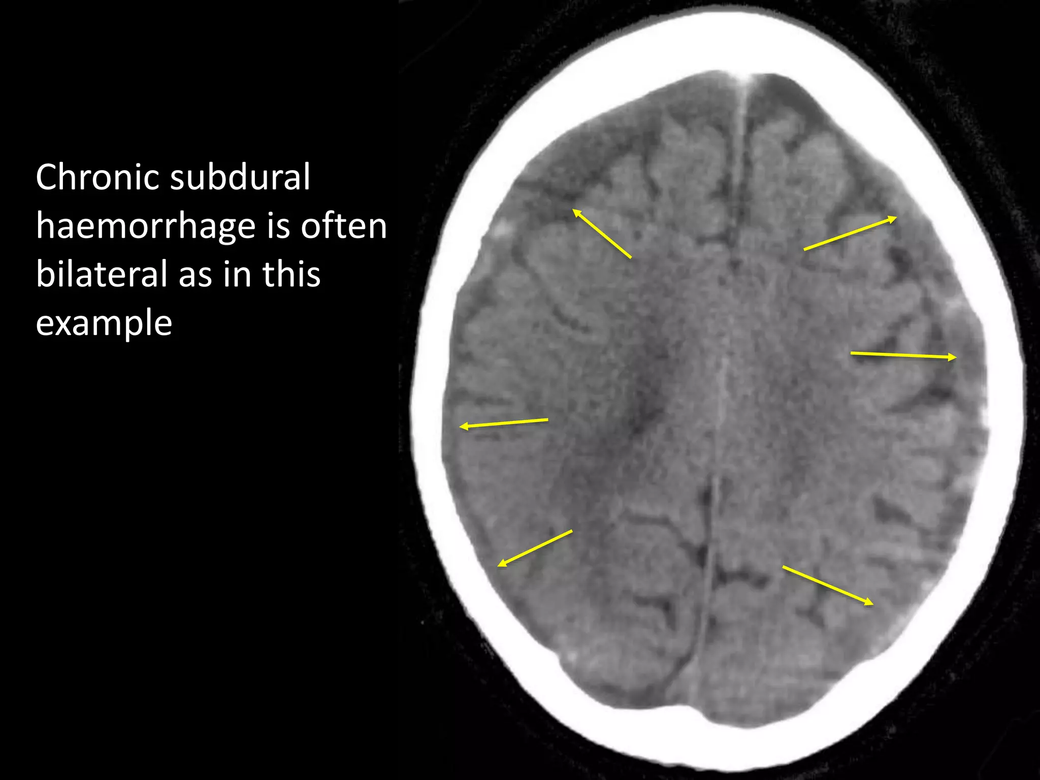 CT of acute intracranial pathology | PPTX