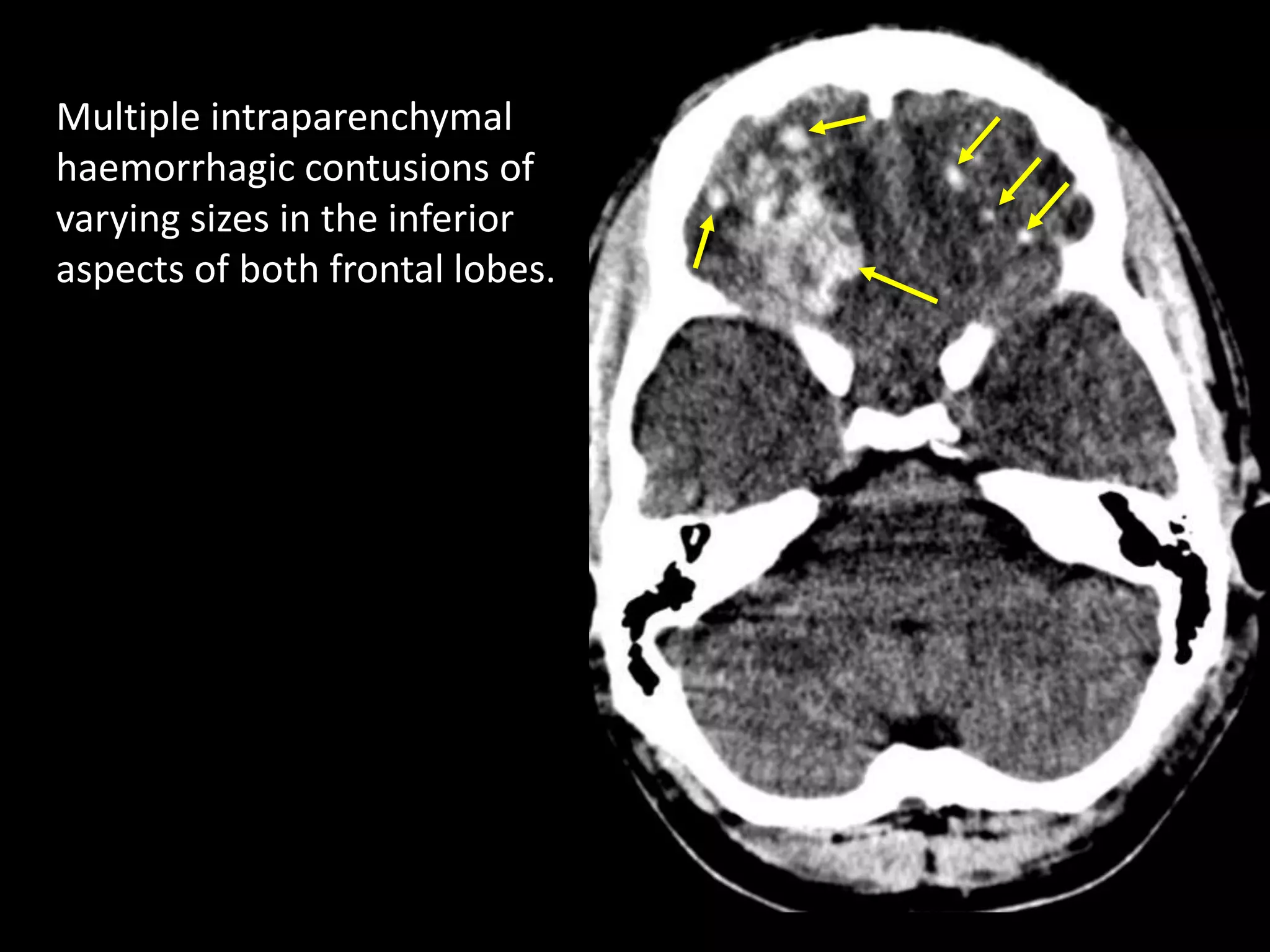 CT of acute intracranial pathology | PPTX