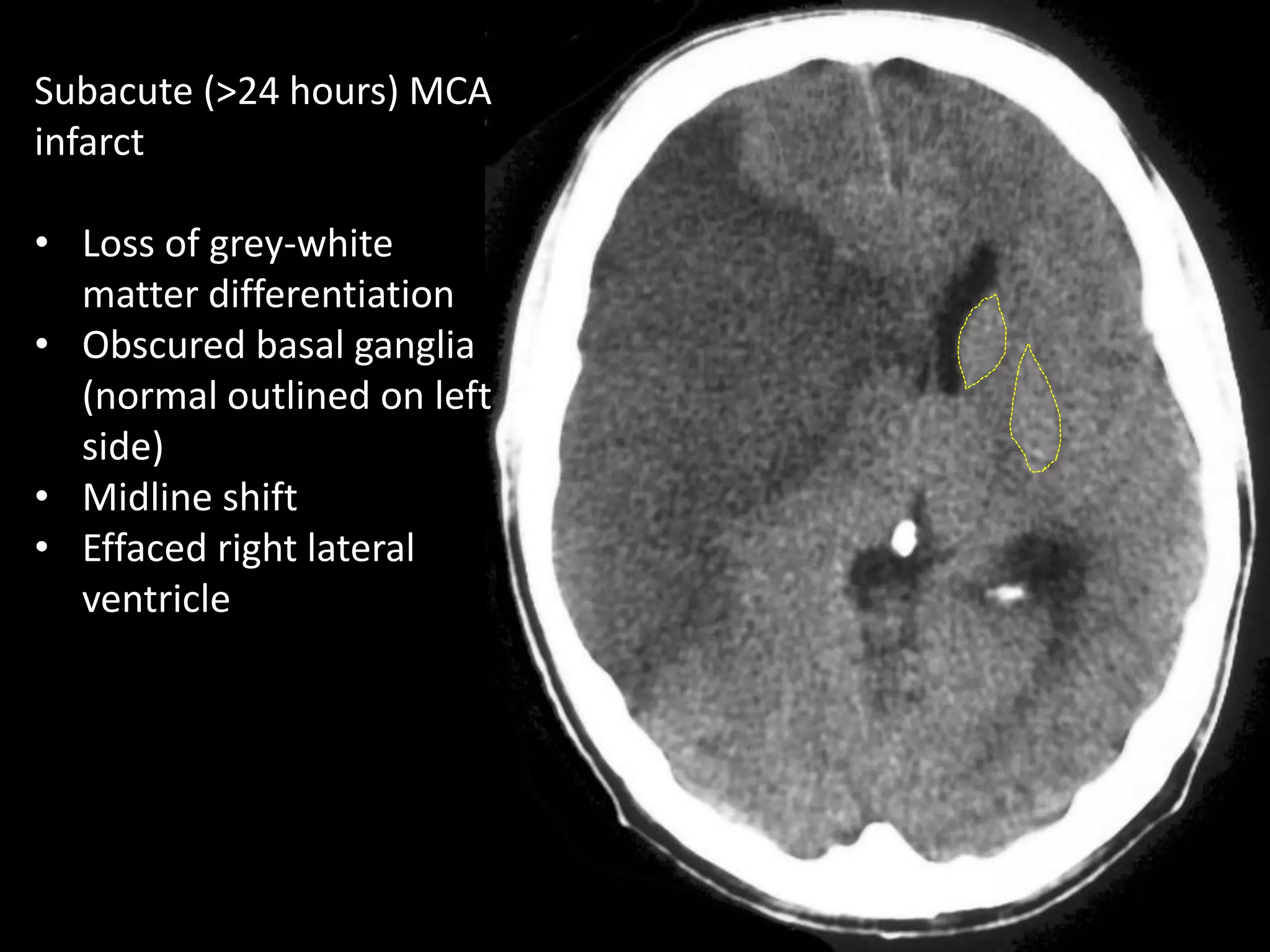 CT of acute intracranial pathology | PPTX