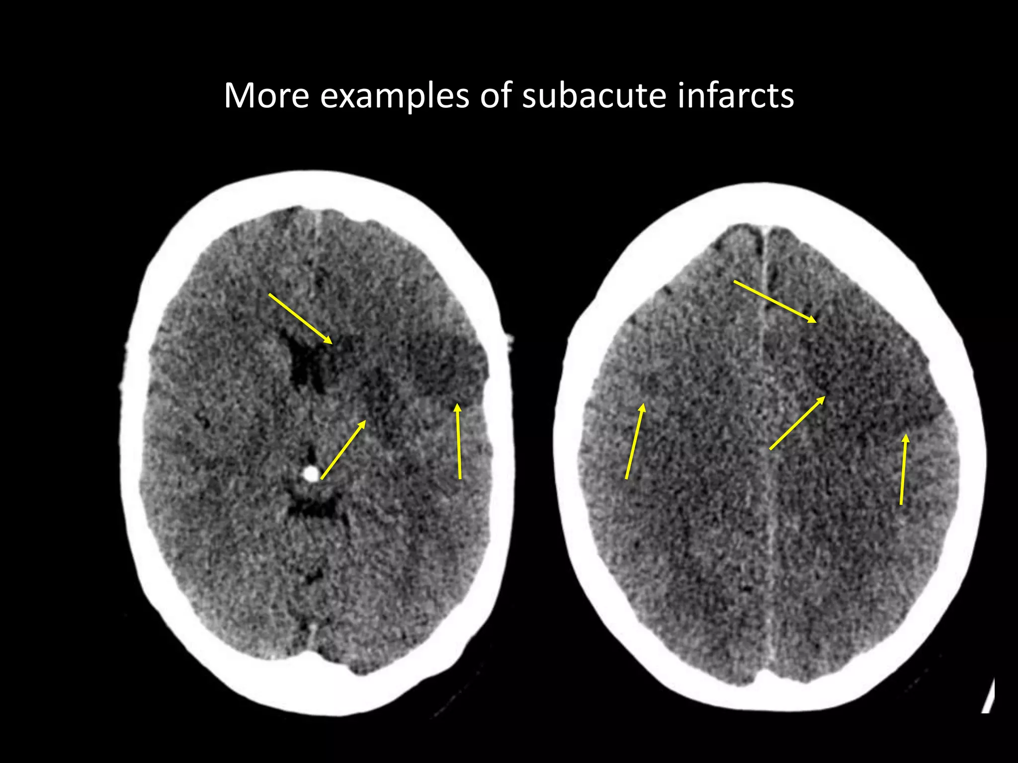 CT of acute intracranial pathology | PPT