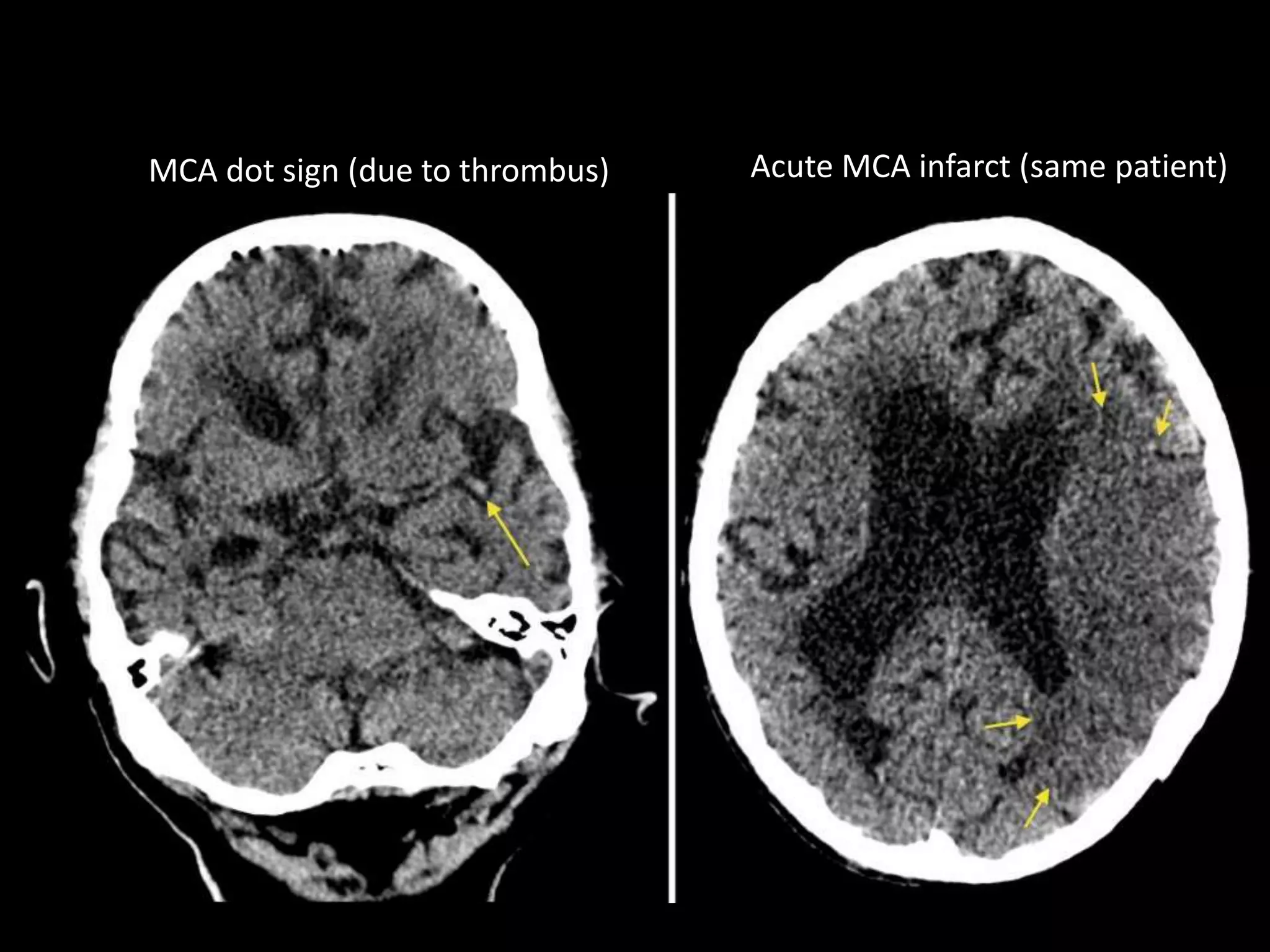 CT of acute intracranial pathology | PPT