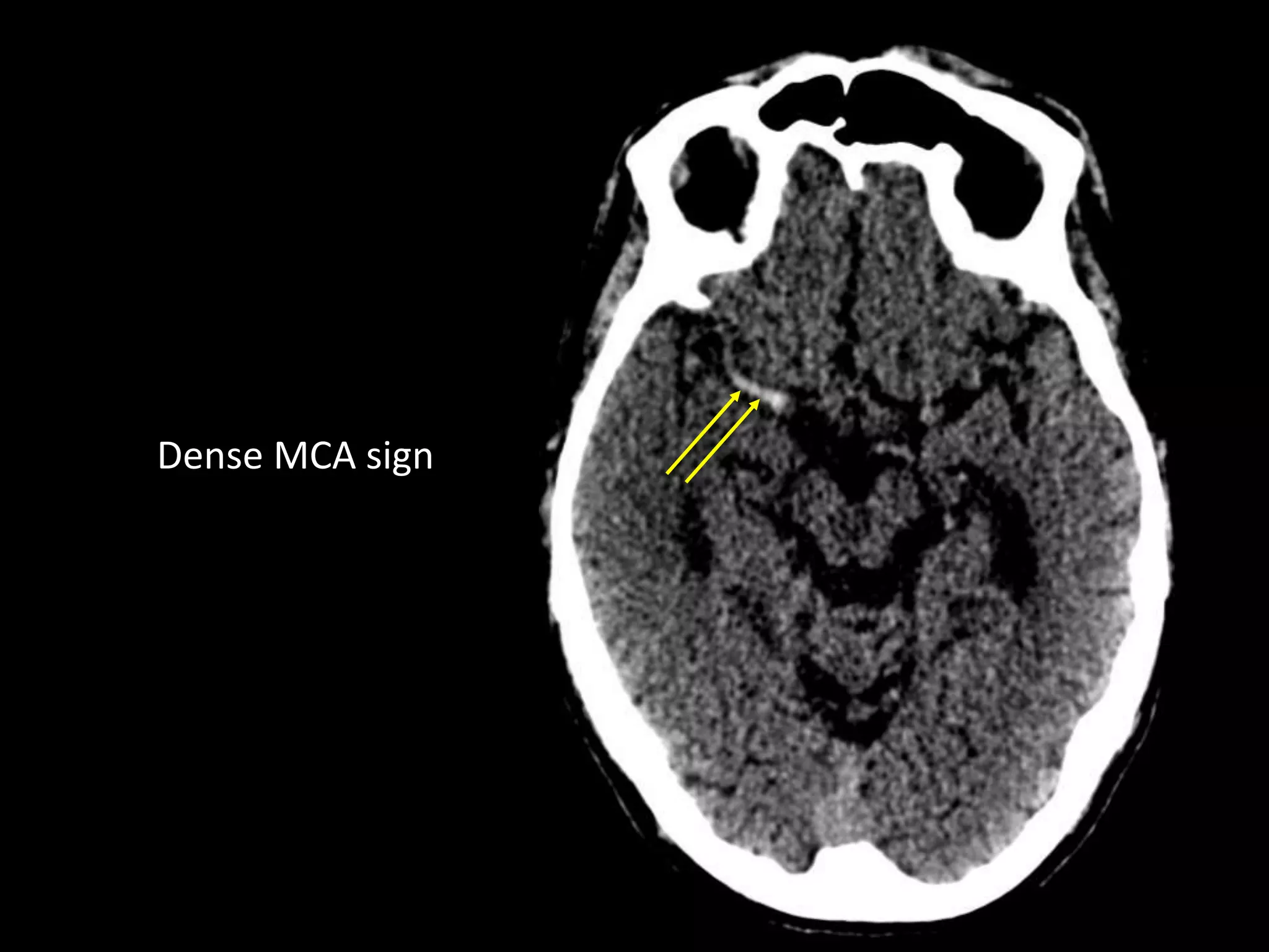 CT of acute intracranial pathology | PPTX