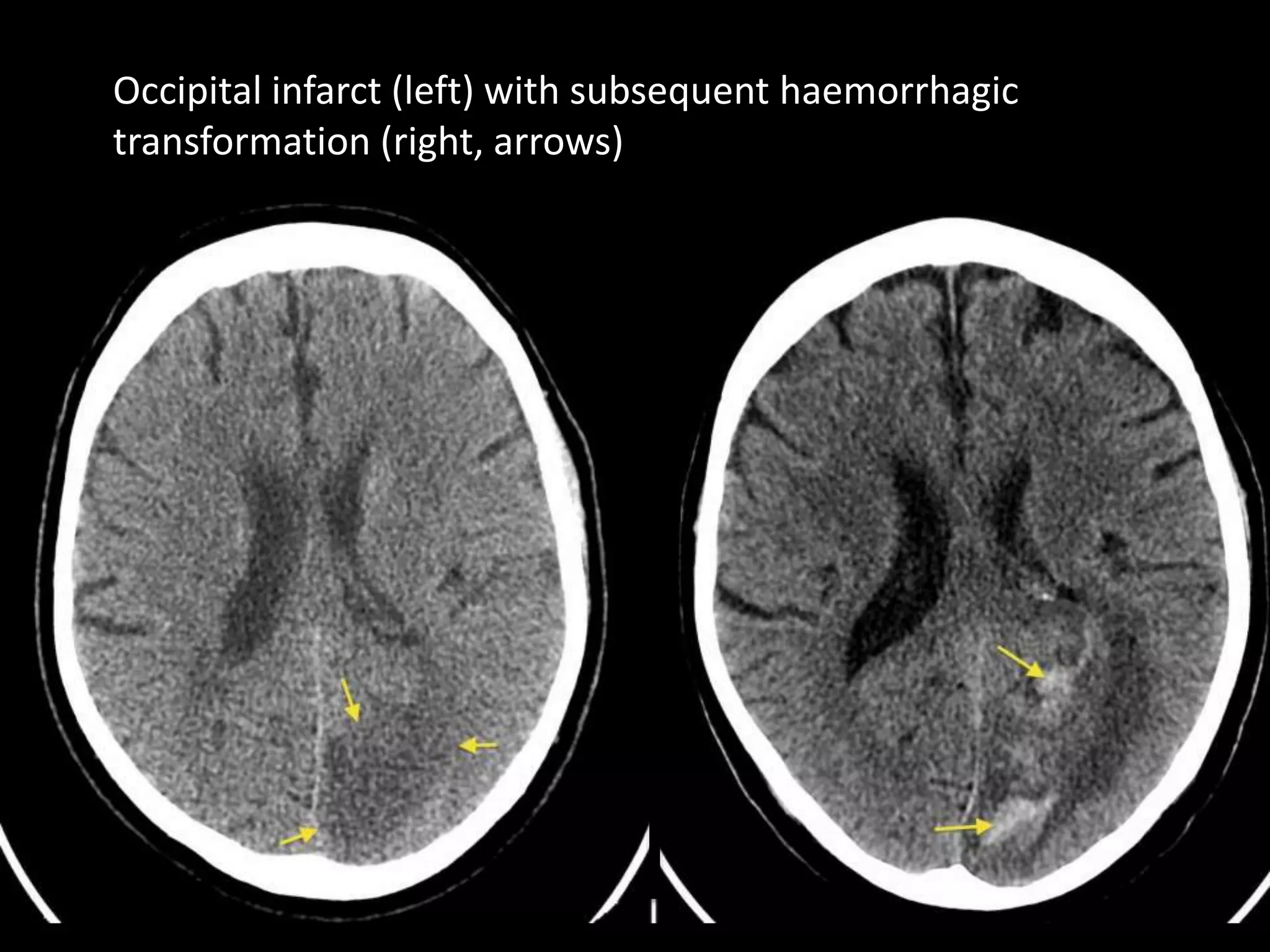CT of acute intracranial pathology | PPT
