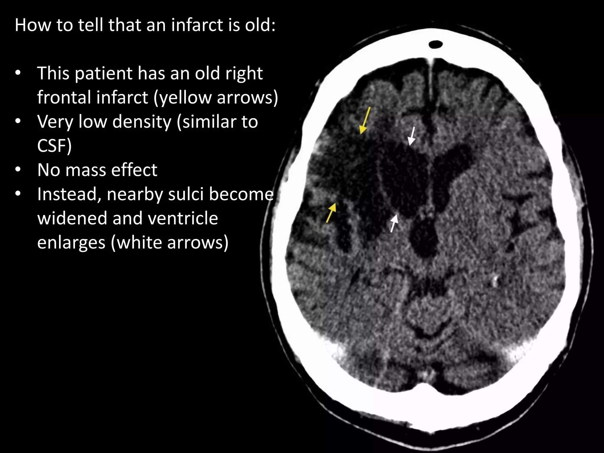 CT of acute intracranial pathology | PPTX