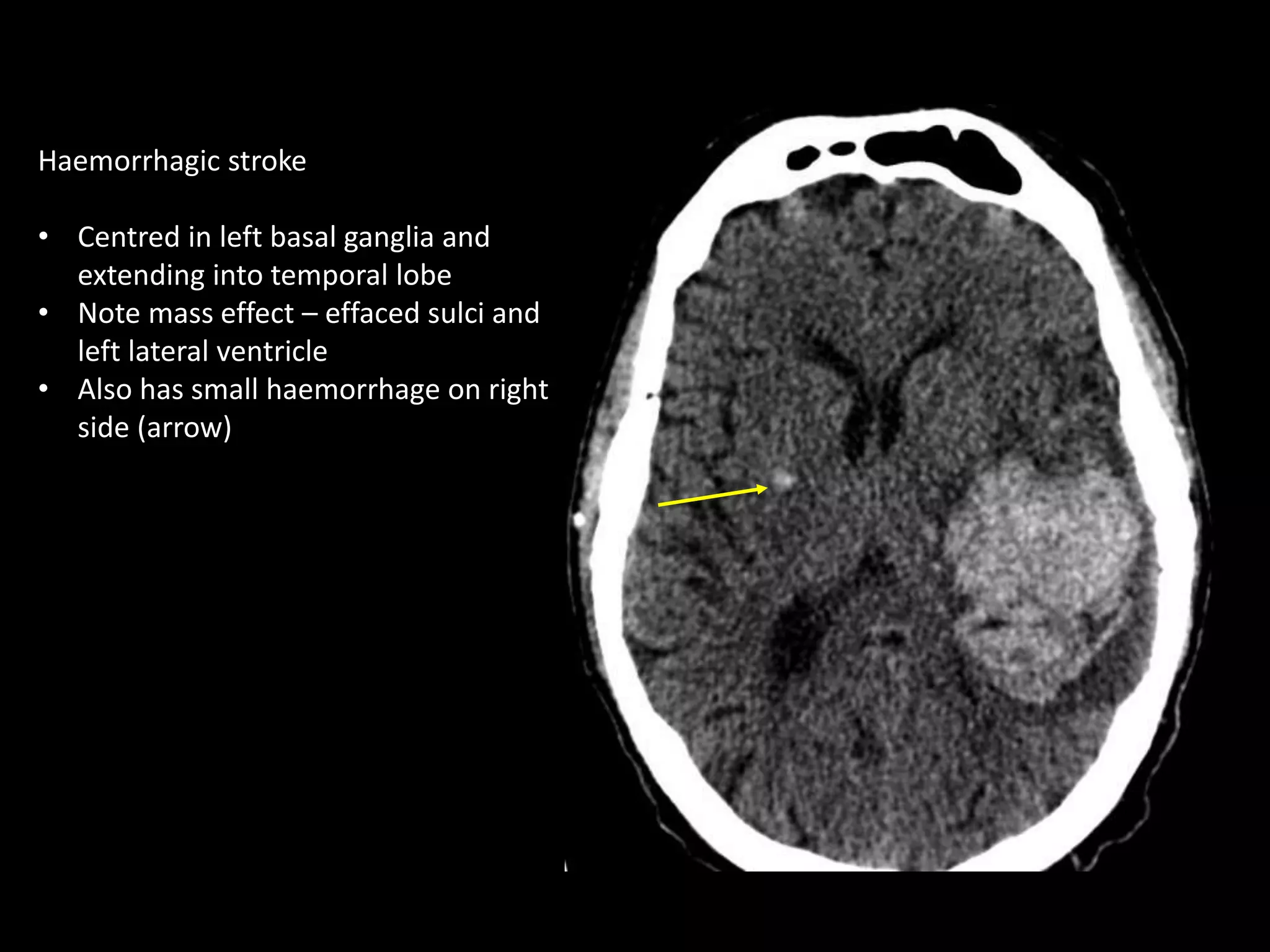CT of acute intracranial pathology | PPTX