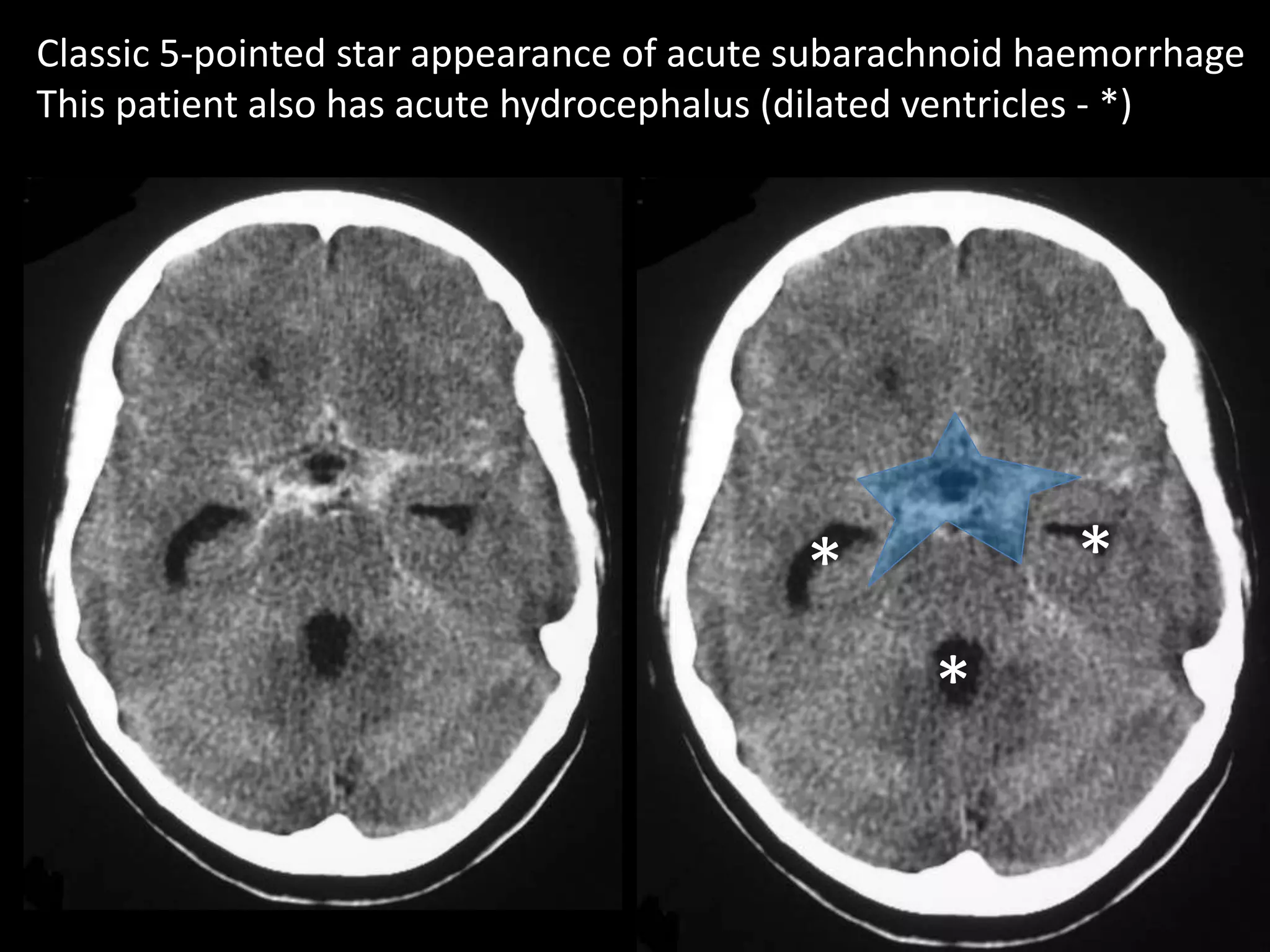 CT of acute intracranial pathology | PPTX