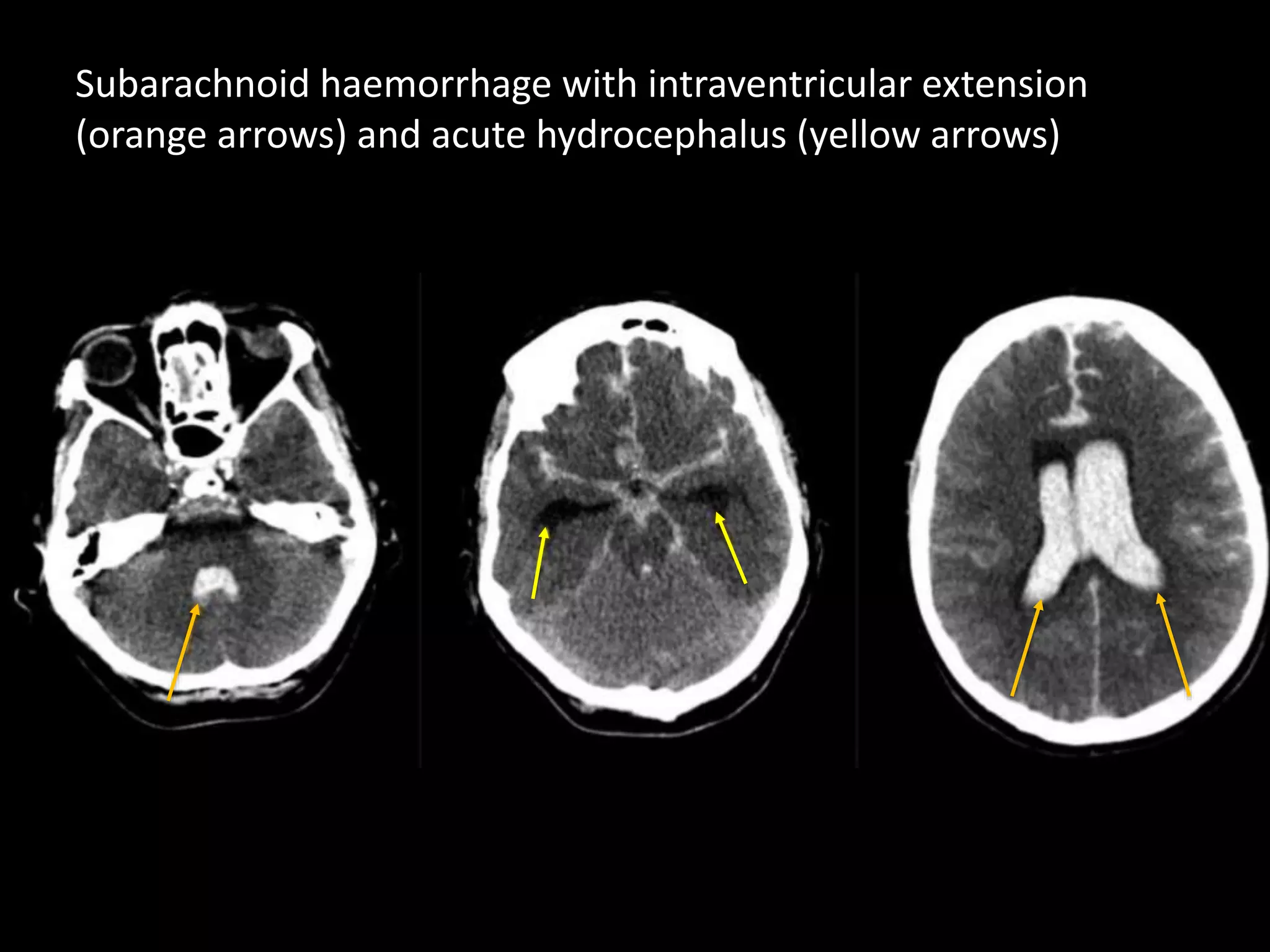 CT of acute intracranial pathology | PPTX