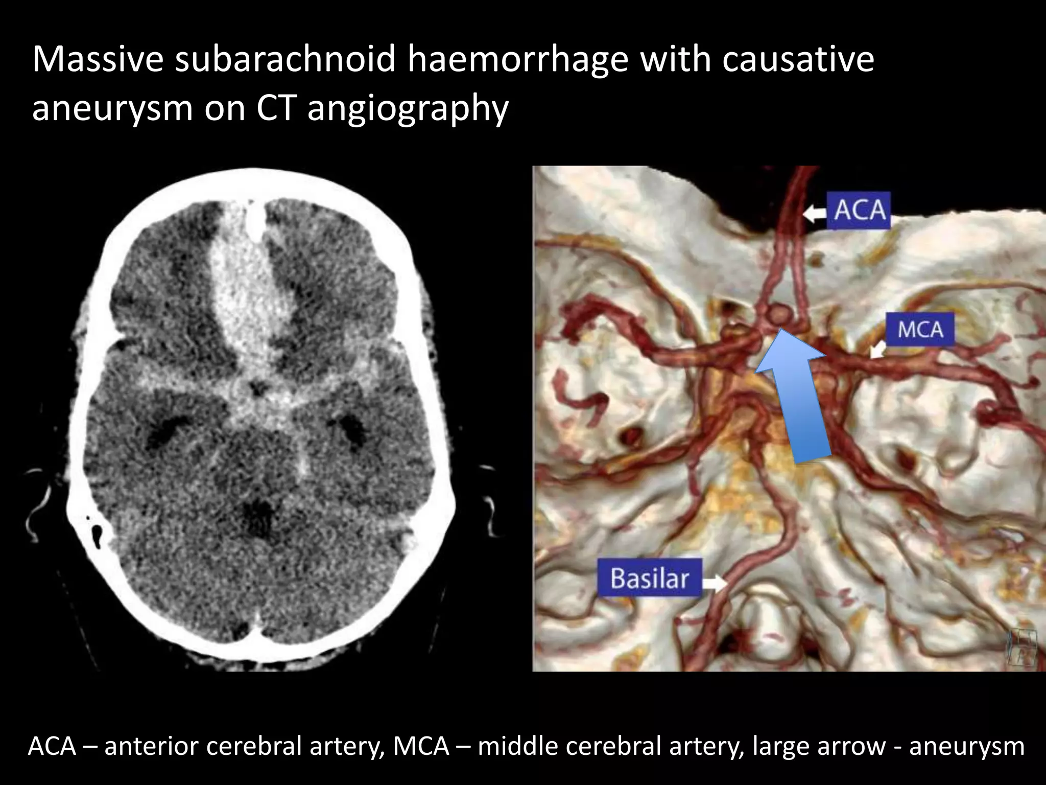 CT of acute intracranial pathology | PPTX