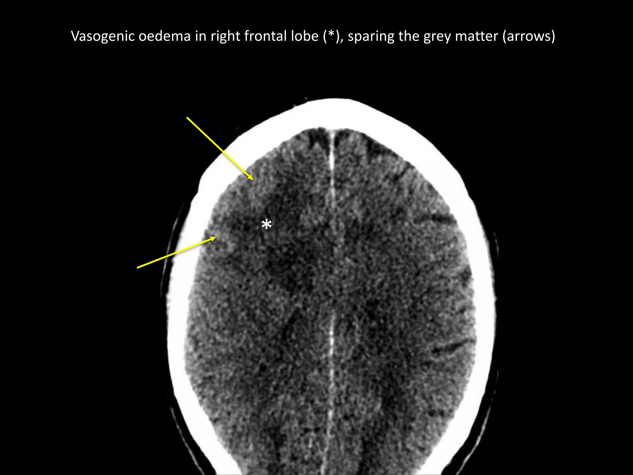 CT of acute intracranial pathology | PPTX