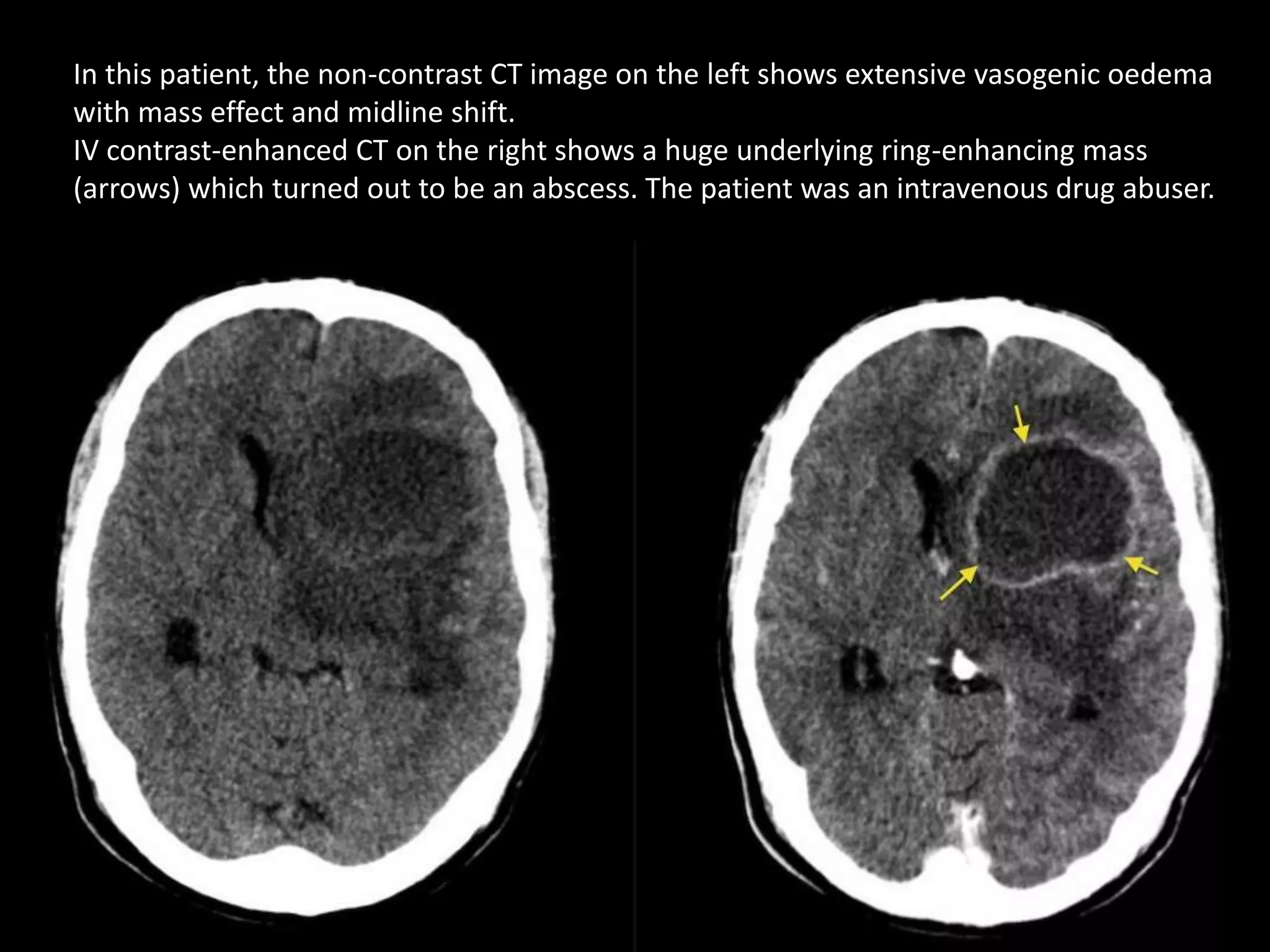 CT of acute intracranial pathology | PPTX