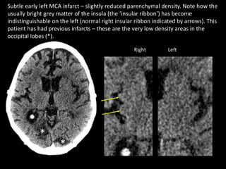 CT of acute intracranial pathology | PPTX