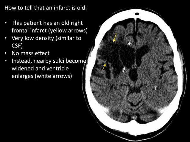 CT of acute intracranial pathology | PPT