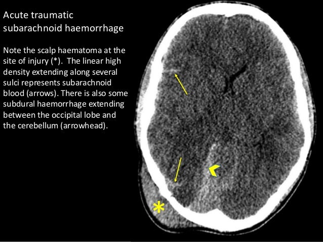 CT of acute intracranial pathology