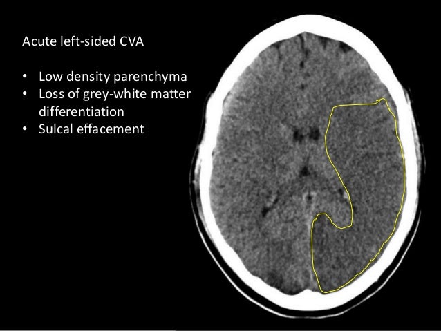 CT of acute intracranial pathology