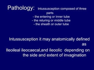 Acute intussusception | PPT