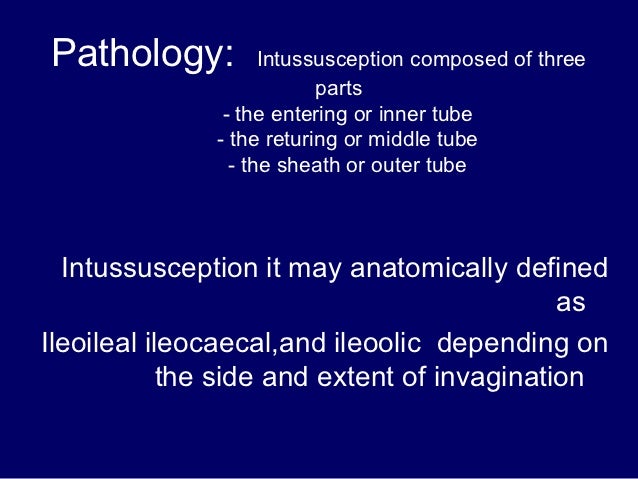 Acute intussusception