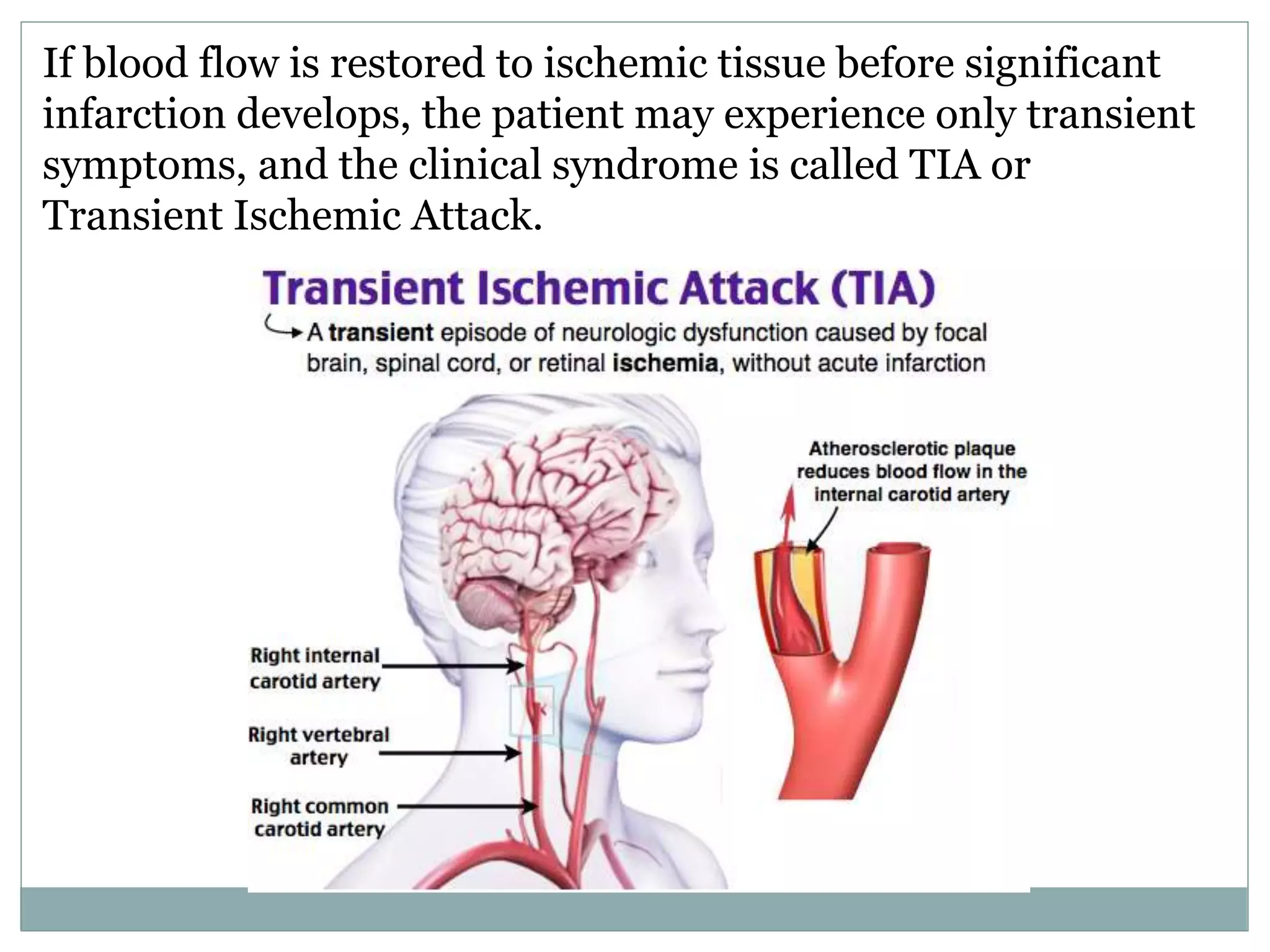 ACUTE ISCHEMIC STROKE.pptx