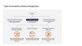 ACUTE ISCHEMIC STROKE.pptx