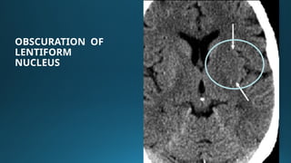 Acute Ischemic Stroke Made By Doctor Sana | PPTX