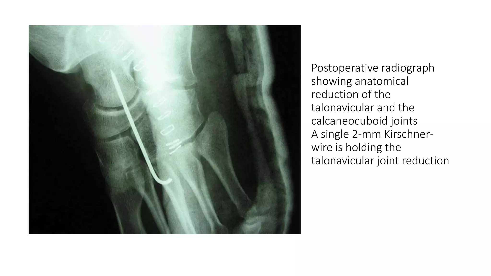 Acute isolated medial midtarsal dislocation | PDF