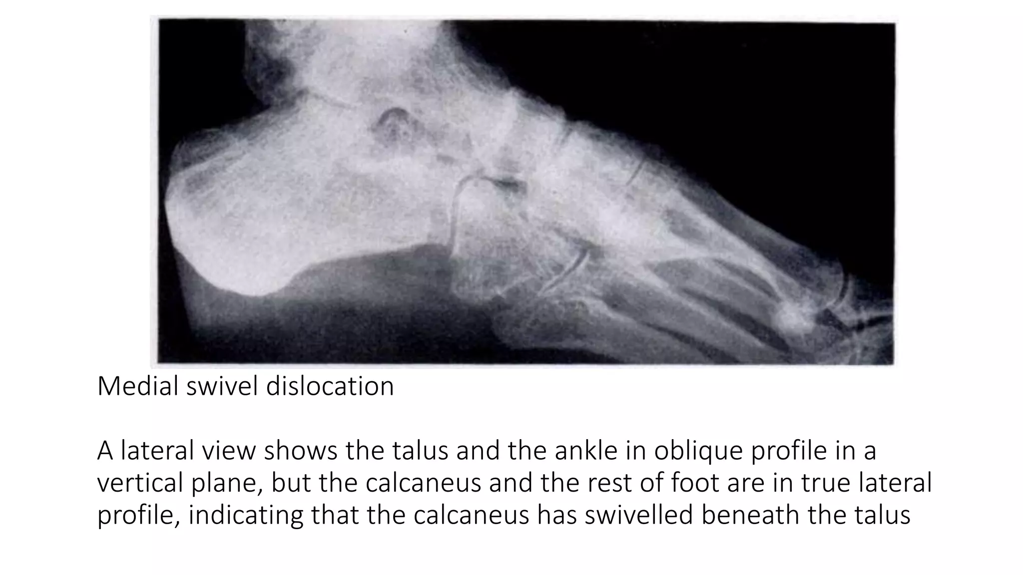 Acute isolated medial midtarsal dislocation | PDF