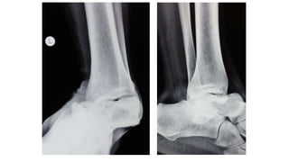 Acute isolated medial midtarsal dislocation | PDF