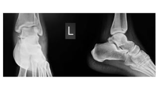 Acute isolated medial midtarsal dislocation | PDF