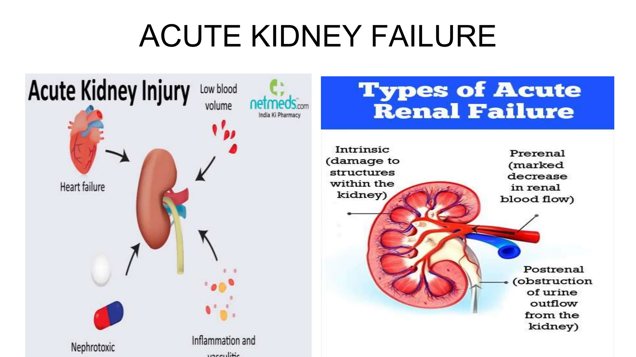 ACUTE KIDNEY FAILURE: A comprehensive study | PPT