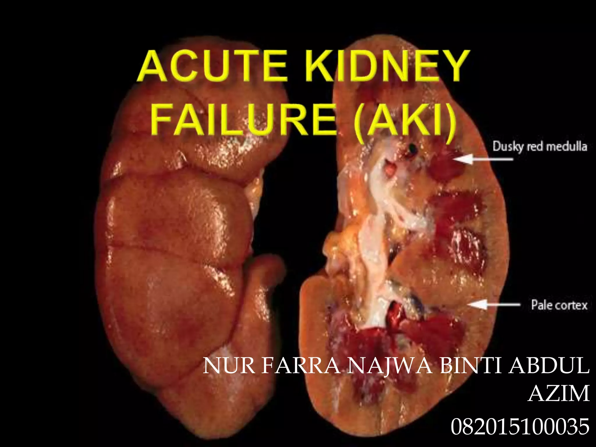 Acute kidney failure (aki) | PPTX
