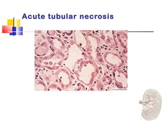 Acute kidney Injury | PPT