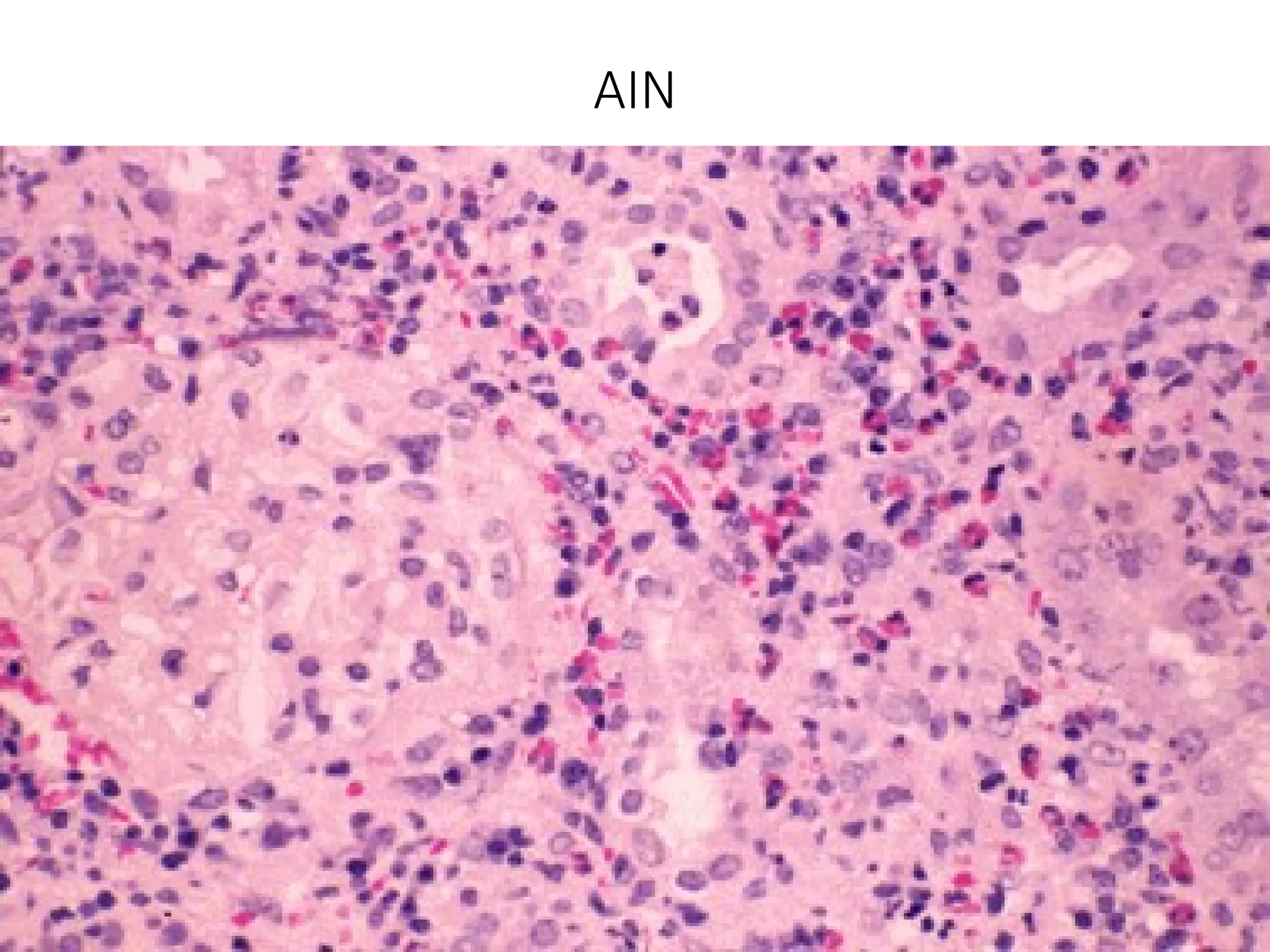 An overview of acute kidney injury/Acute renal disease.ppt