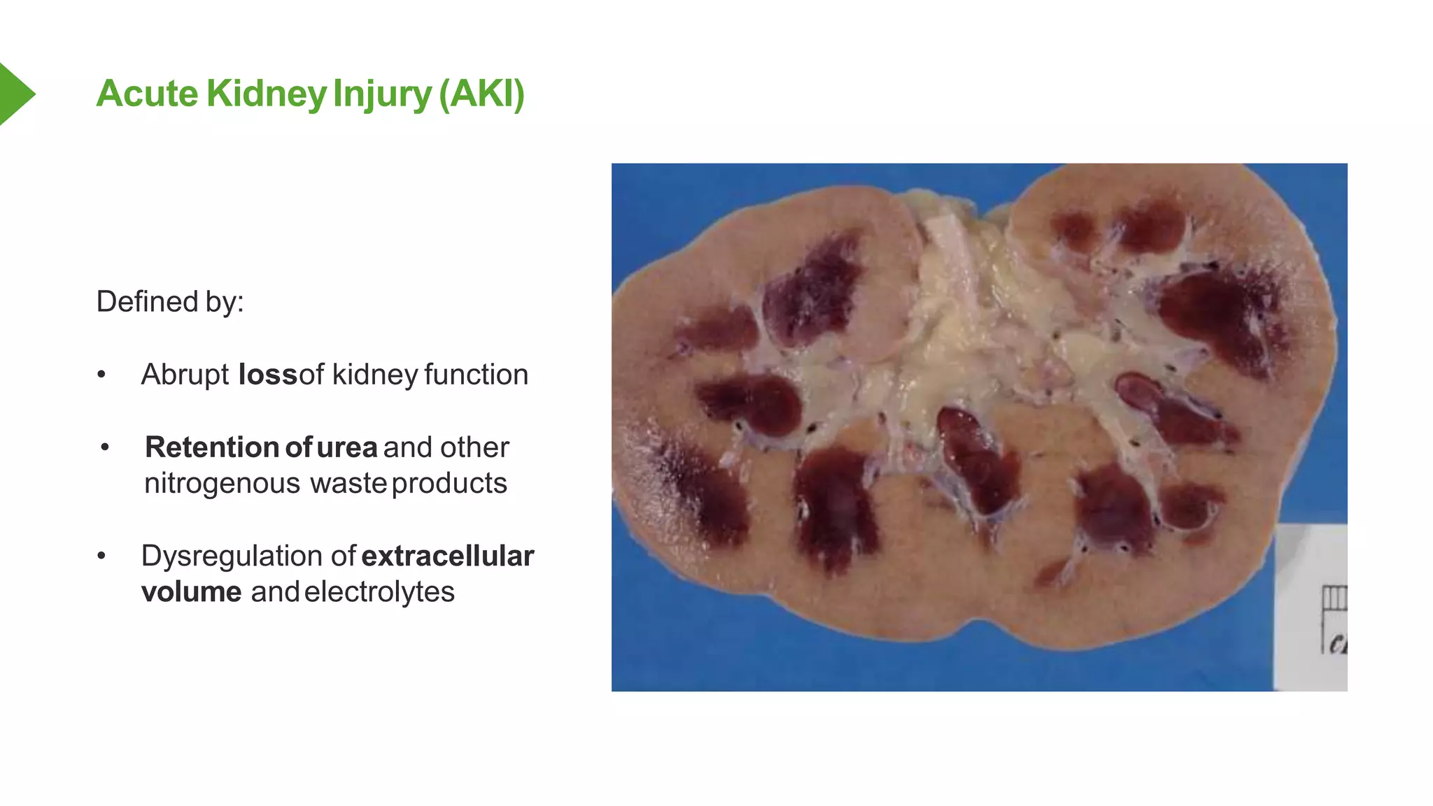 Acute Kidney injury nephrology.pptx