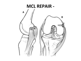 Acute knee ligament injuries | PPT