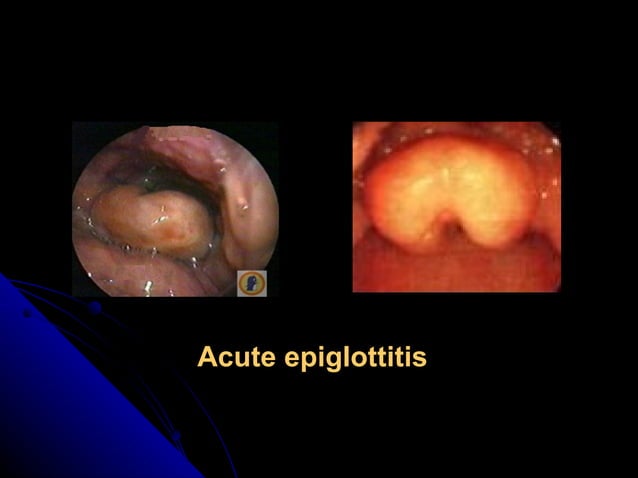 E.N.T.Acute laryngitis.(dr.usif chalabe) | PPT | Ear, Nose and Throat ...