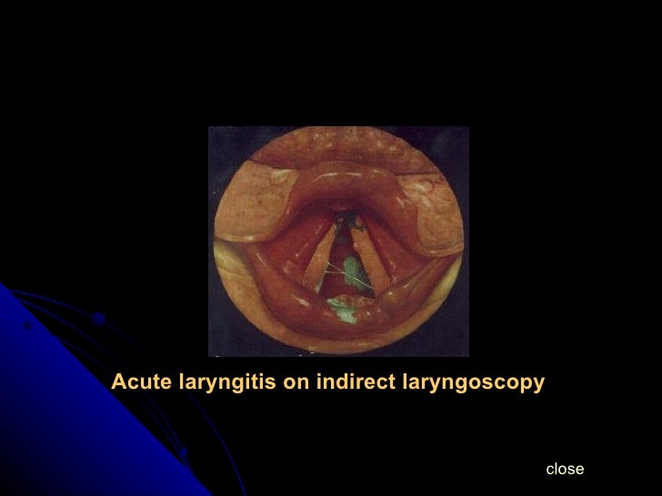 E.N.T.Acute laryngitis.(dr.usif chalabe)