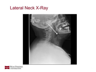 Laryngitis X Ray