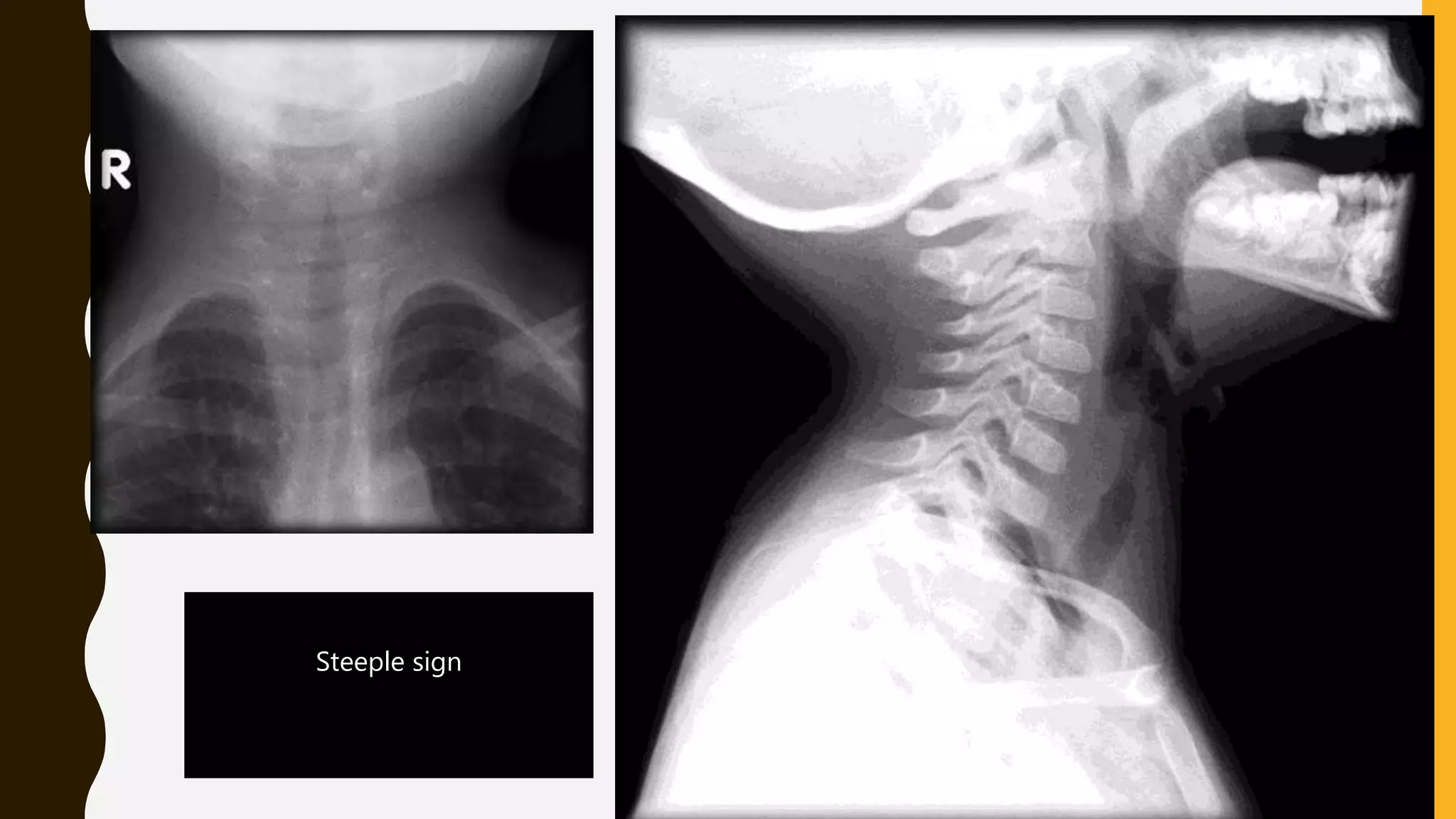 Acute laryngotracheobronchitis bondi | PPTX