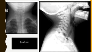 Acute laryngotracheobronchitis bondi | PPTX