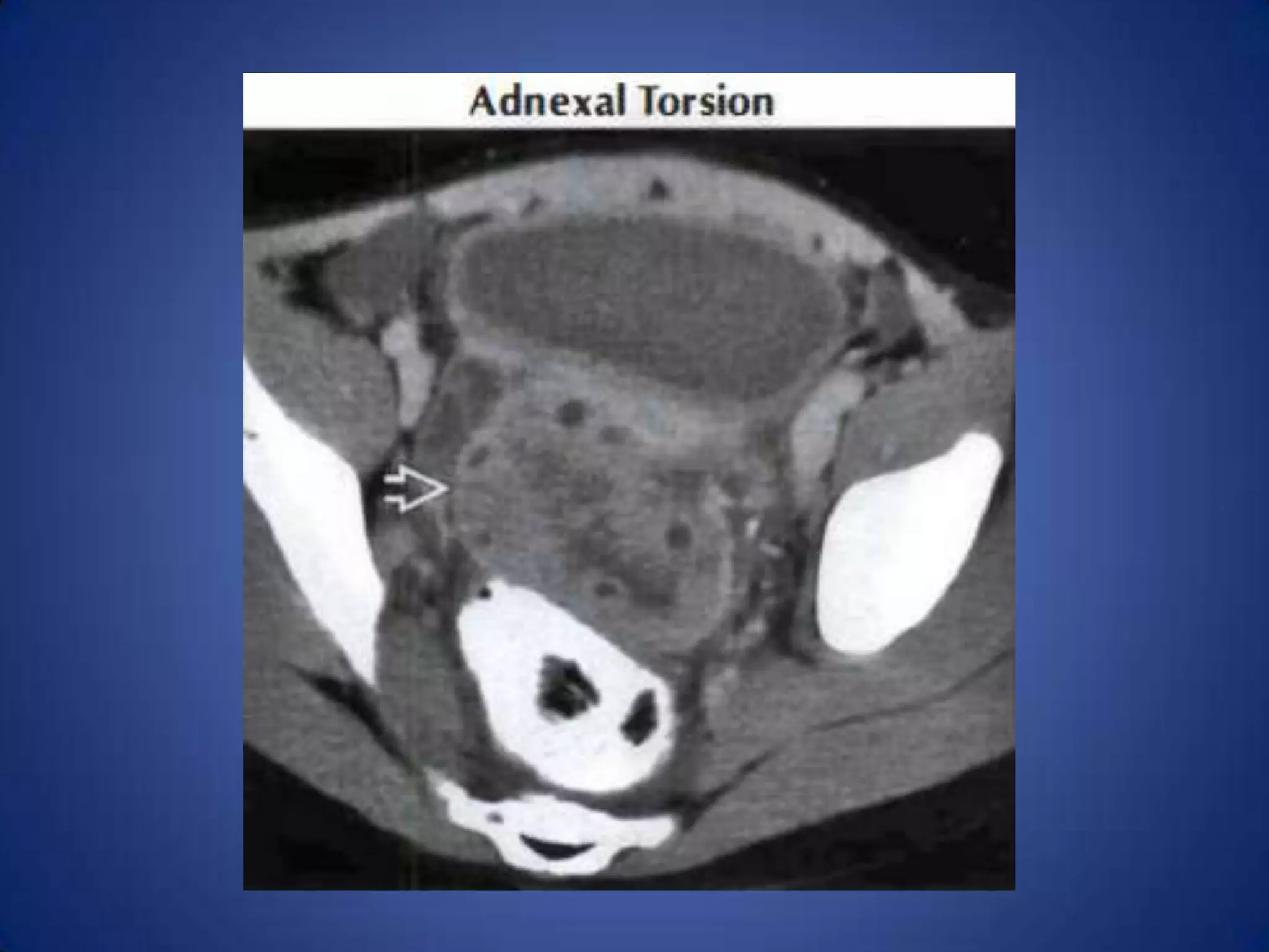 ACUTE LEFT LOWER QUADRANT PAIN | PDF