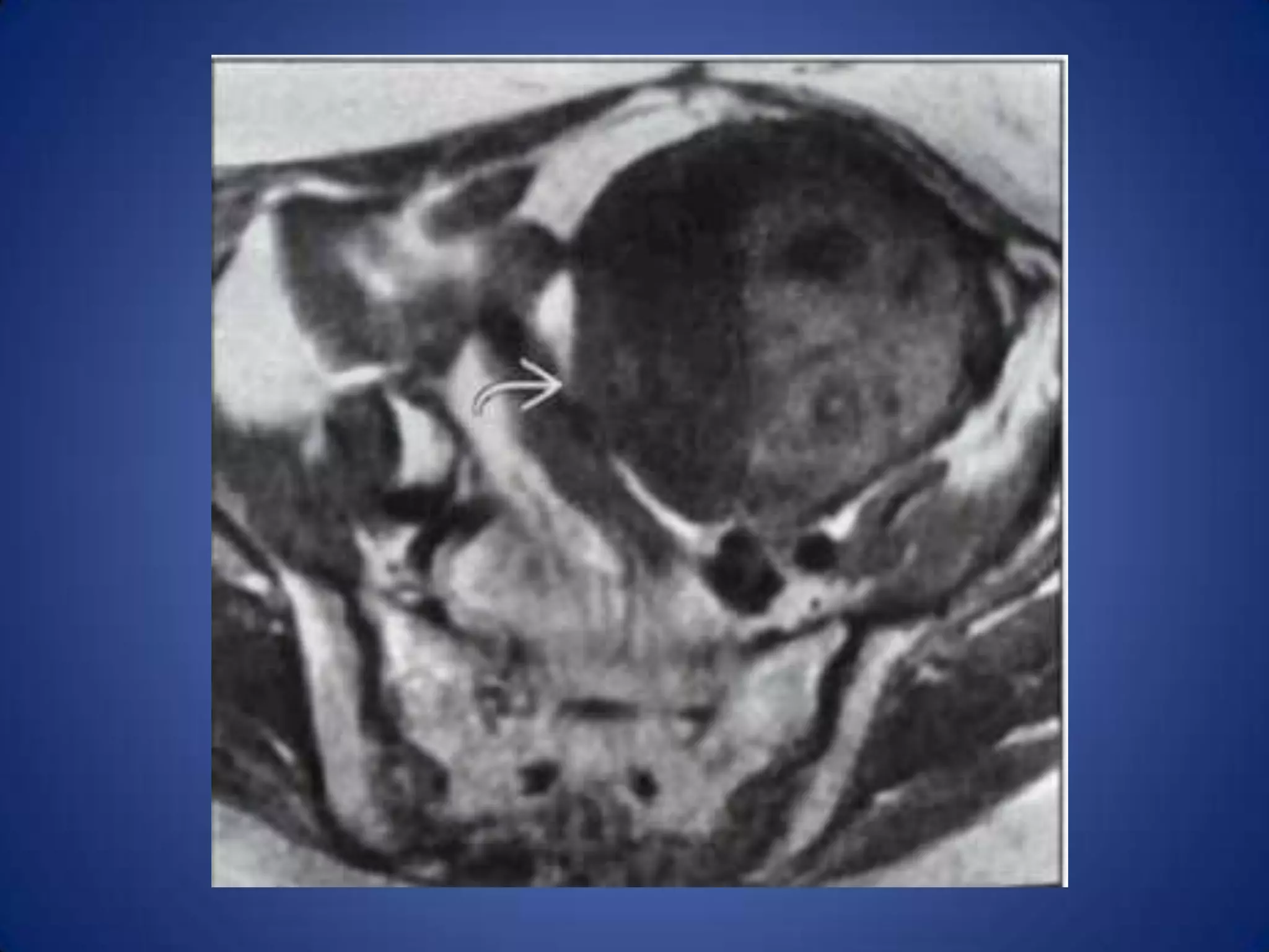 ACUTE LEFT LOWER QUADRANT PAIN | PDF