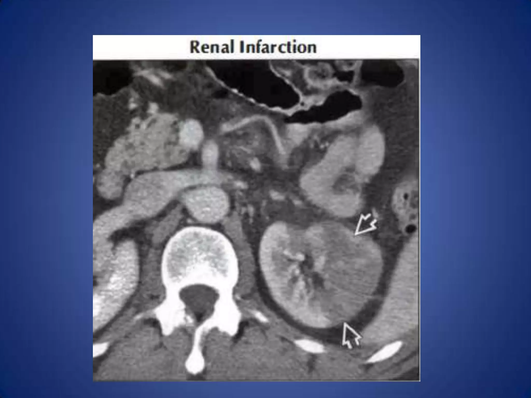 ACUTE LEFT LOWER QUADRANT PAIN | PDF