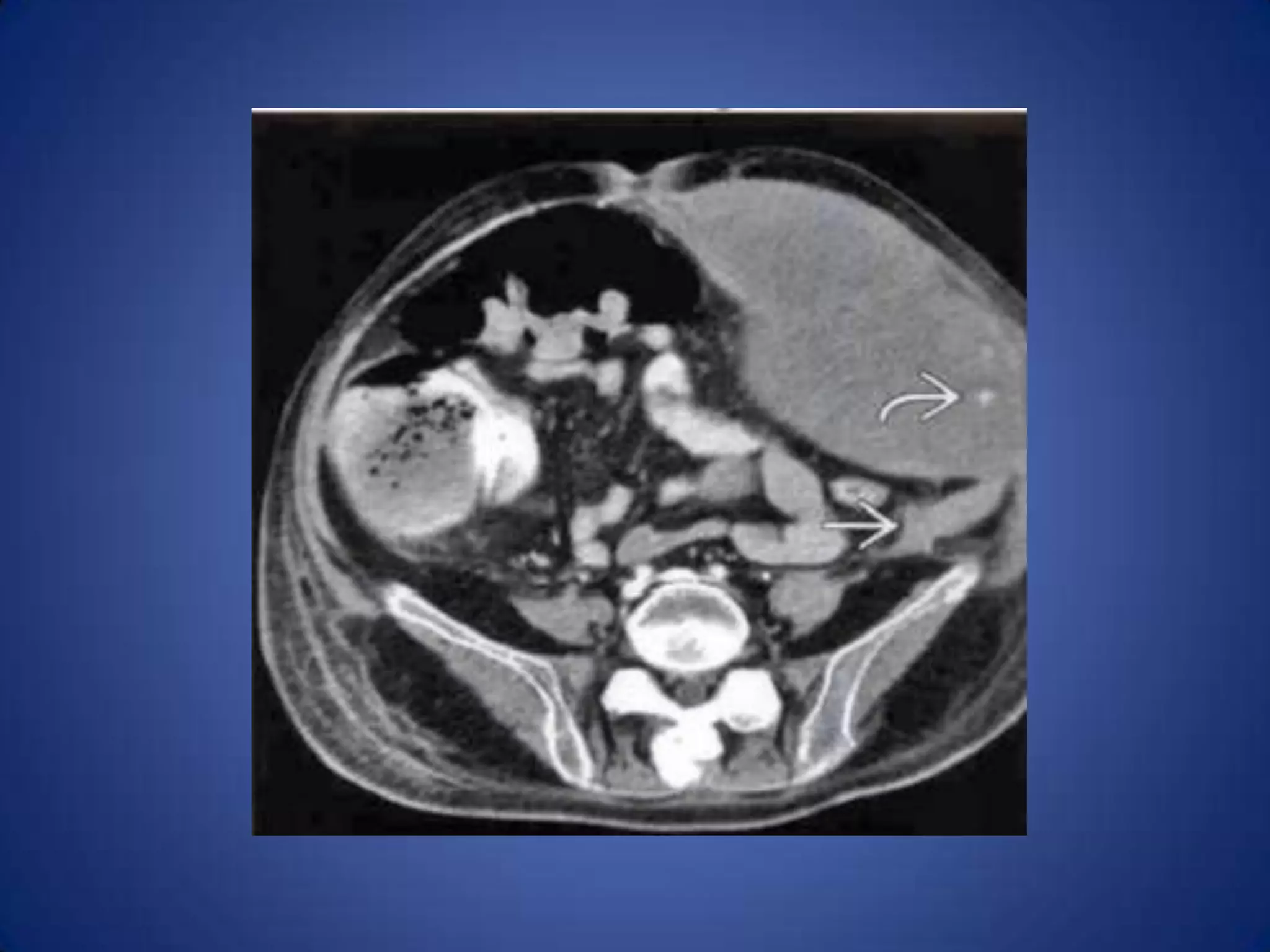 ACUTE LEFT LOWER QUADRANT PAIN | PDF