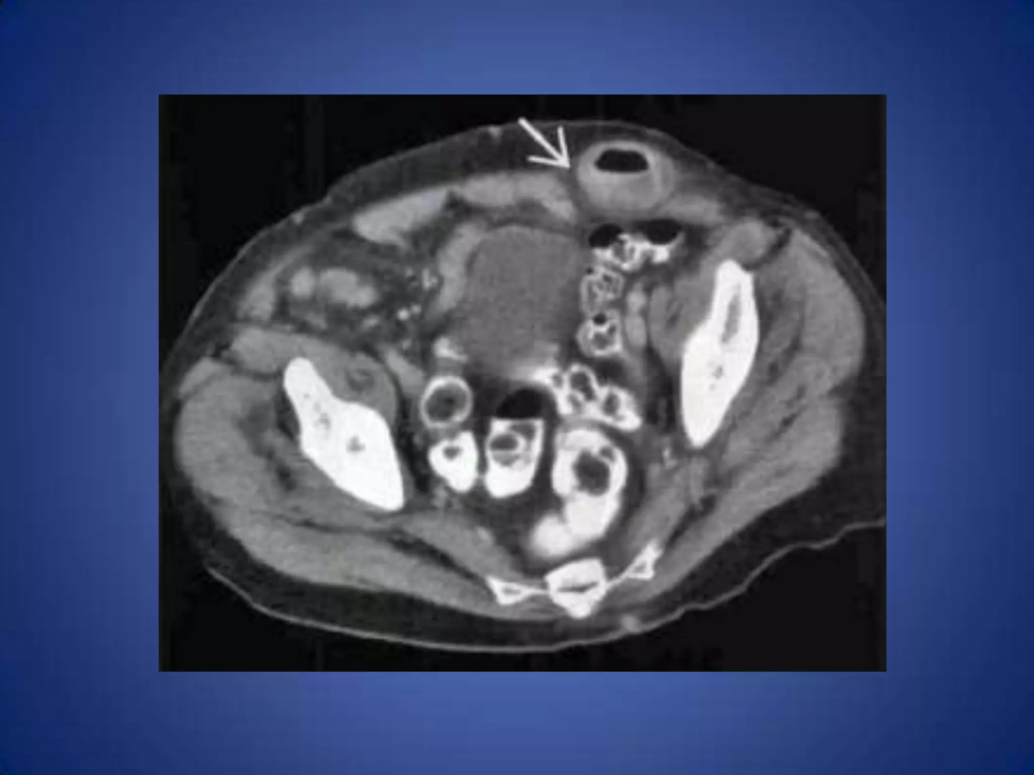 ACUTE LEFT LOWER QUADRANT PAIN | PDF