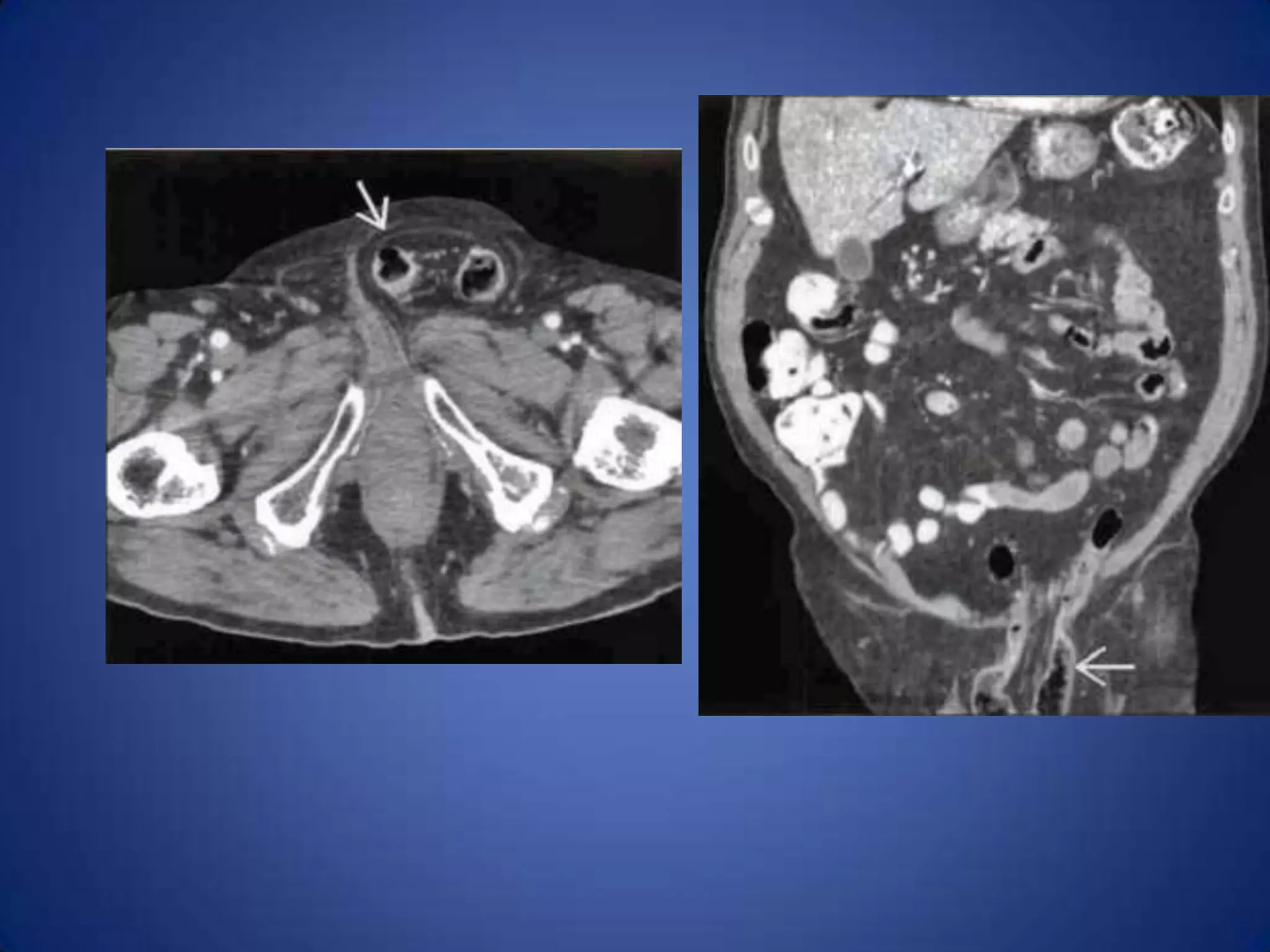 ACUTE LEFT LOWER QUADRANT PAIN | PDF