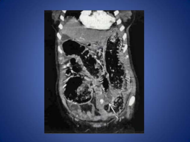 ACUTE LEFT LOWER QUADRANT PAIN | PDF
