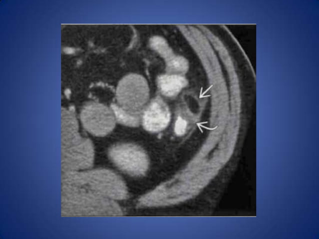 ACUTE LEFT LOWER QUADRANT PAIN | PDF